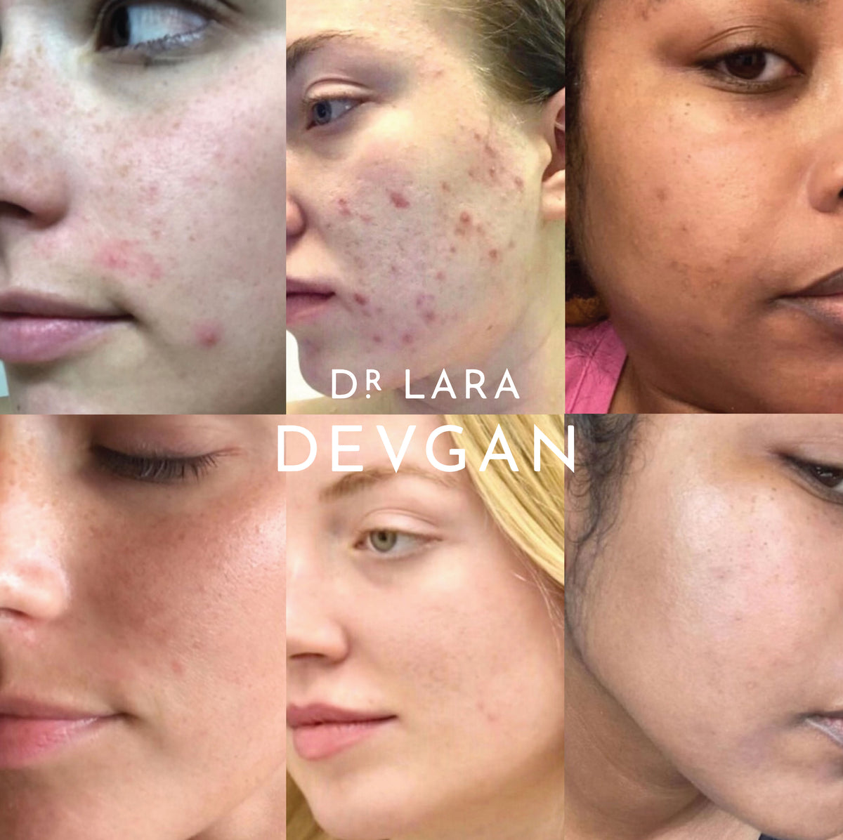 Skin Transformations – Dr. Lara Devgan Skincare
