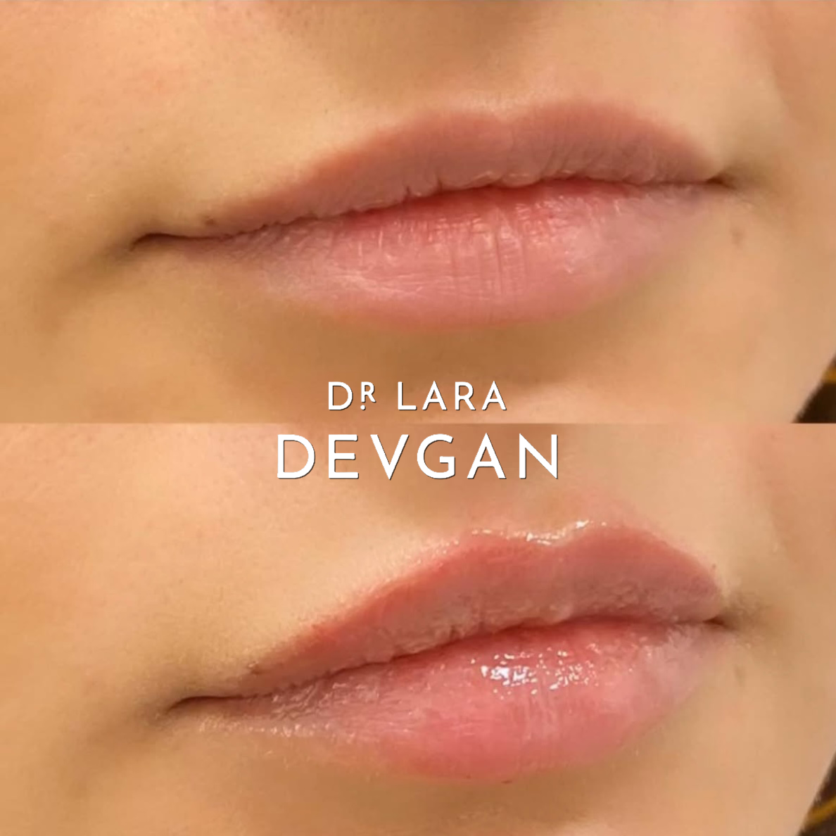 BEAUTY METRICS: Lecture 1 | Lip Augmentation – Dr. Lara Devgan Skincare