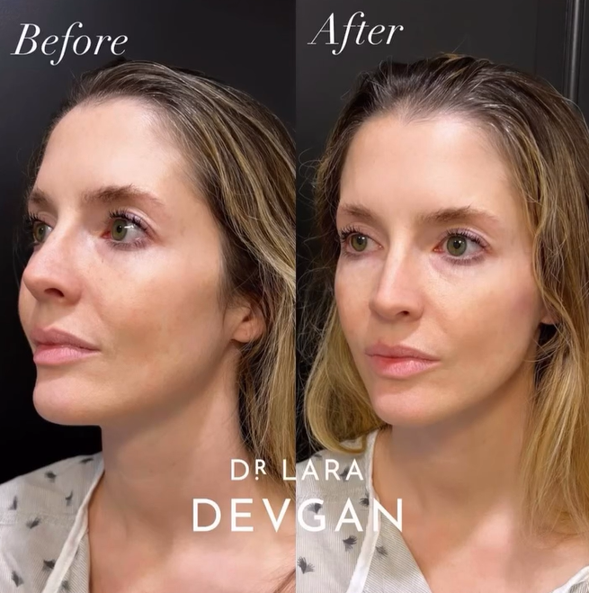 BEAUTY METRICS: Lecture 3 | Suture Suspension – Dr. Lara Devgan Skincare