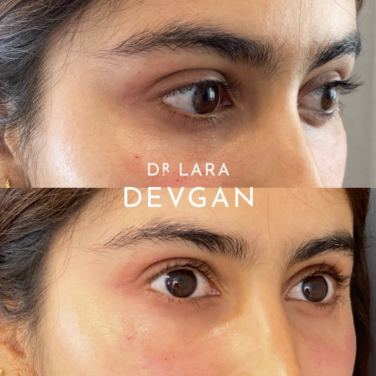 BEAUTY METRICS: Lecture 2 | Tear Trough Augmentation – Dr. Lara Devgan ...